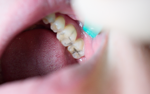 GPHW2022: How Is Silver Diamine Fluoride (SDF) Transforming Dental ...